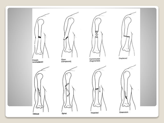 Fraktur Humerus | PPT