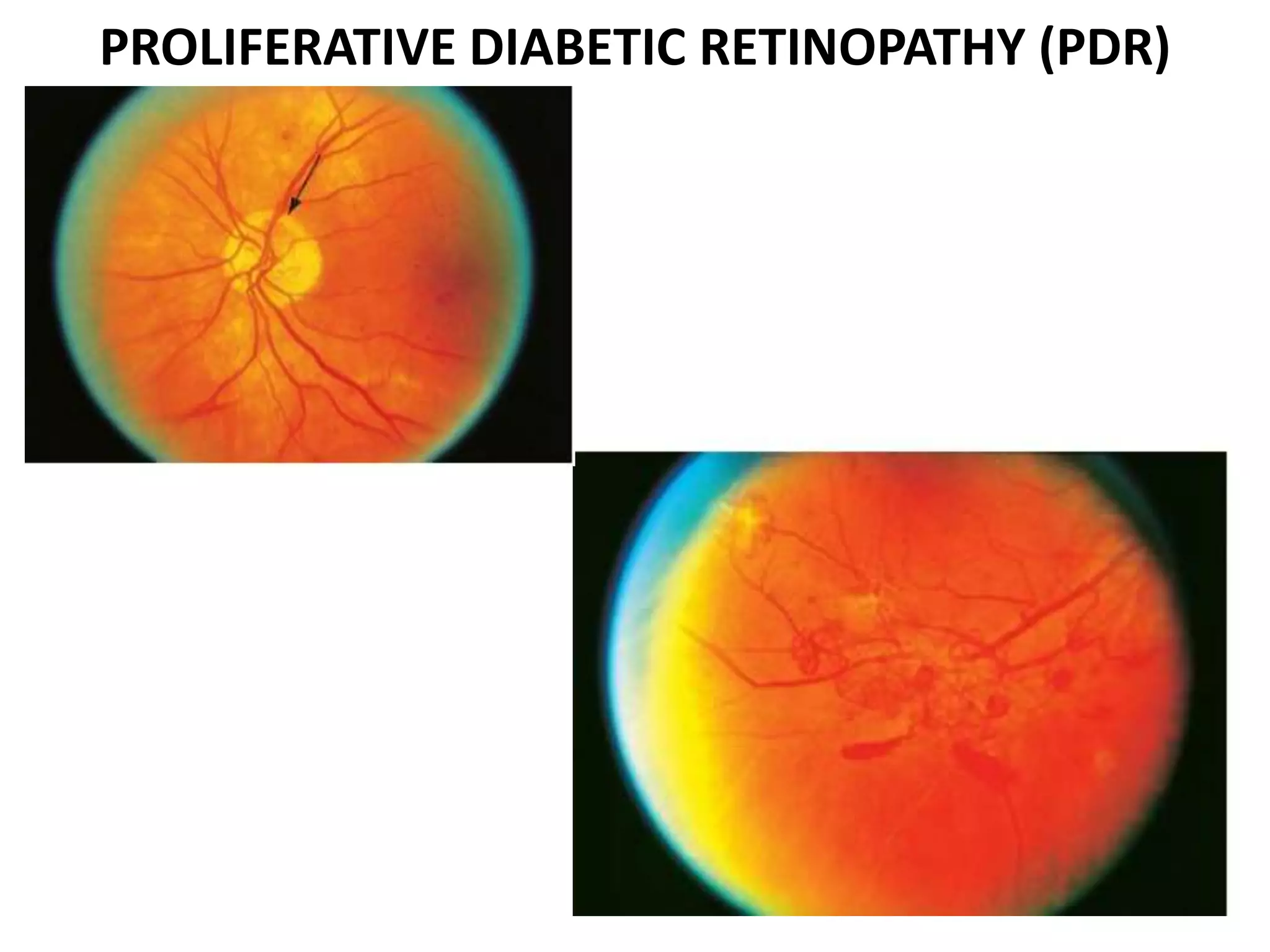DIABETIK RETINOPATI.pptx