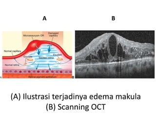 DIABETIK RETINOPATI.pptx