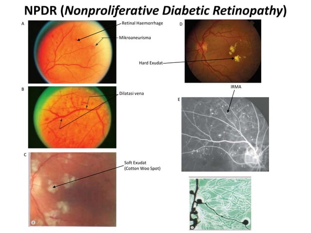 DIABETIK RETINOPATI.pptx