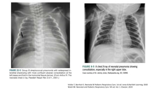 Neonatal Pneumonia in Newborn Neonatal pneumonia | PPTX