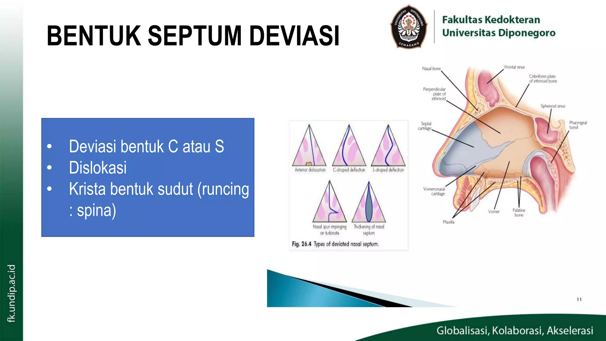 tugas dr. Yan Septum Deviasi (1).pptx