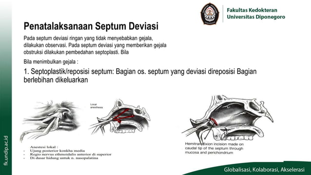 tugas dr. Yan Septum Deviasi (1).pptx
