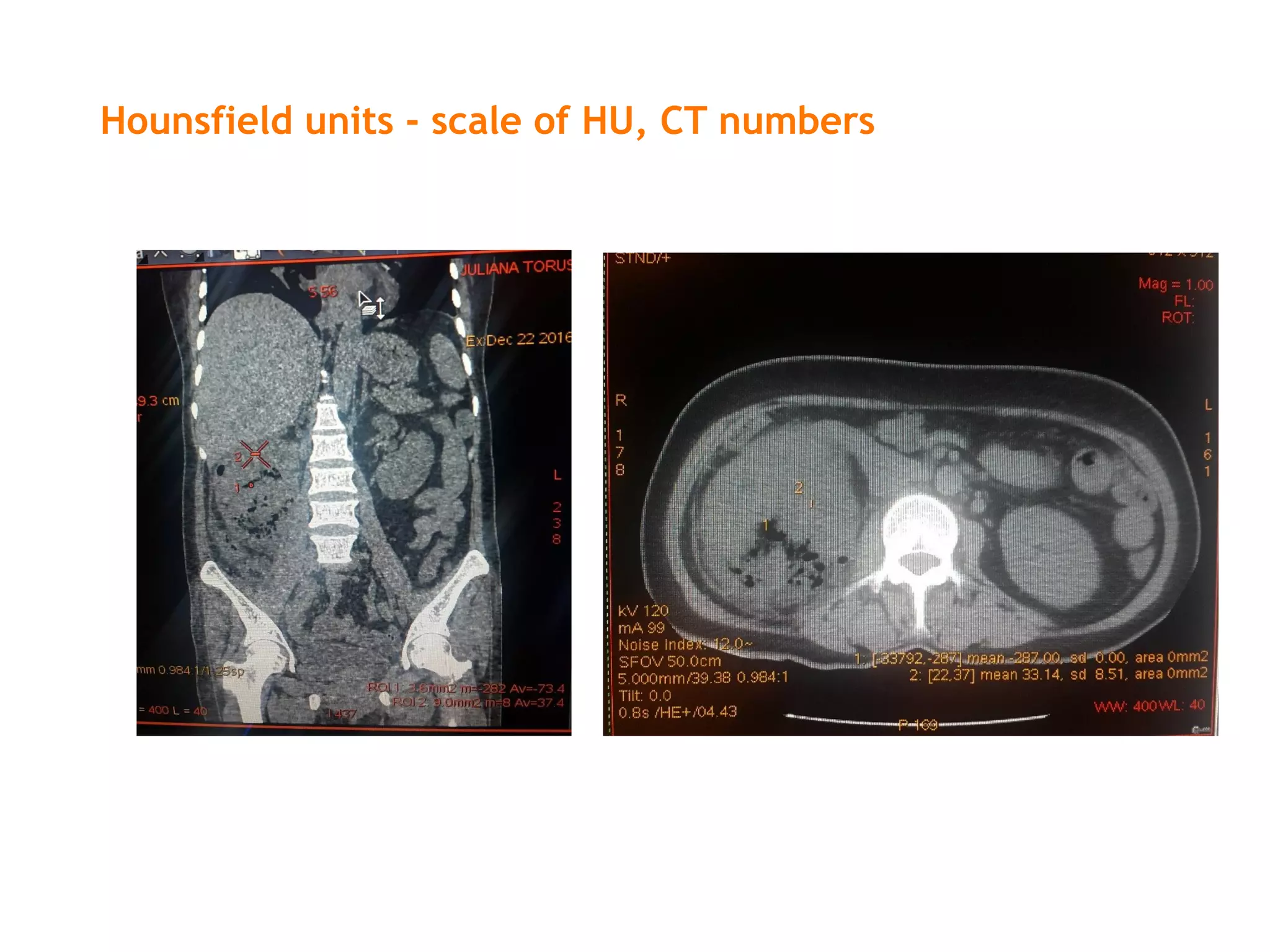 Hounsfield Unit | PPT