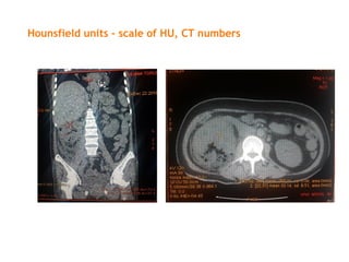 Hounsfield Unit | PPT