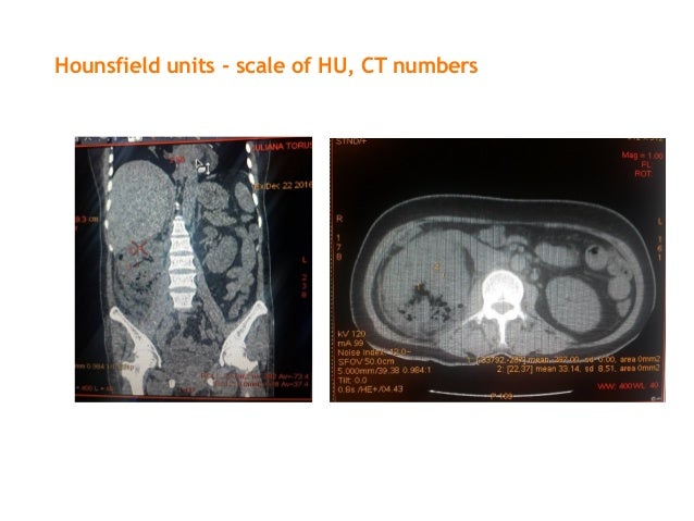 Hounsfield Unit