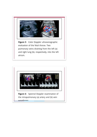 USG pada Tugas Kelainan pada Thorax 2.docx
