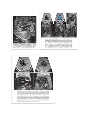 USG pada Tugas Kelainan pada Thorax 2.docx