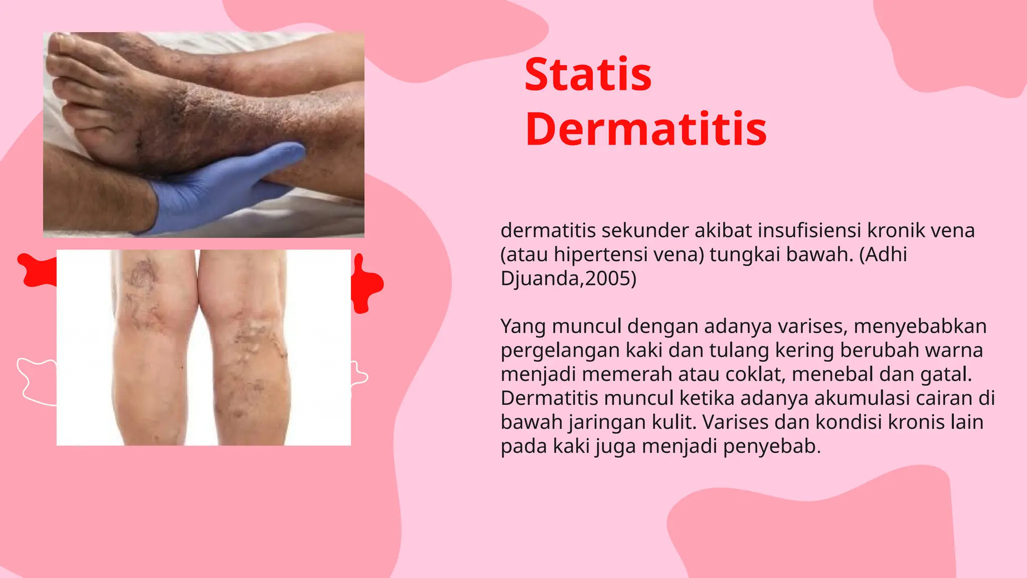 ppt kmb luka bakar dan dermatitis tugas kelompok | PPT