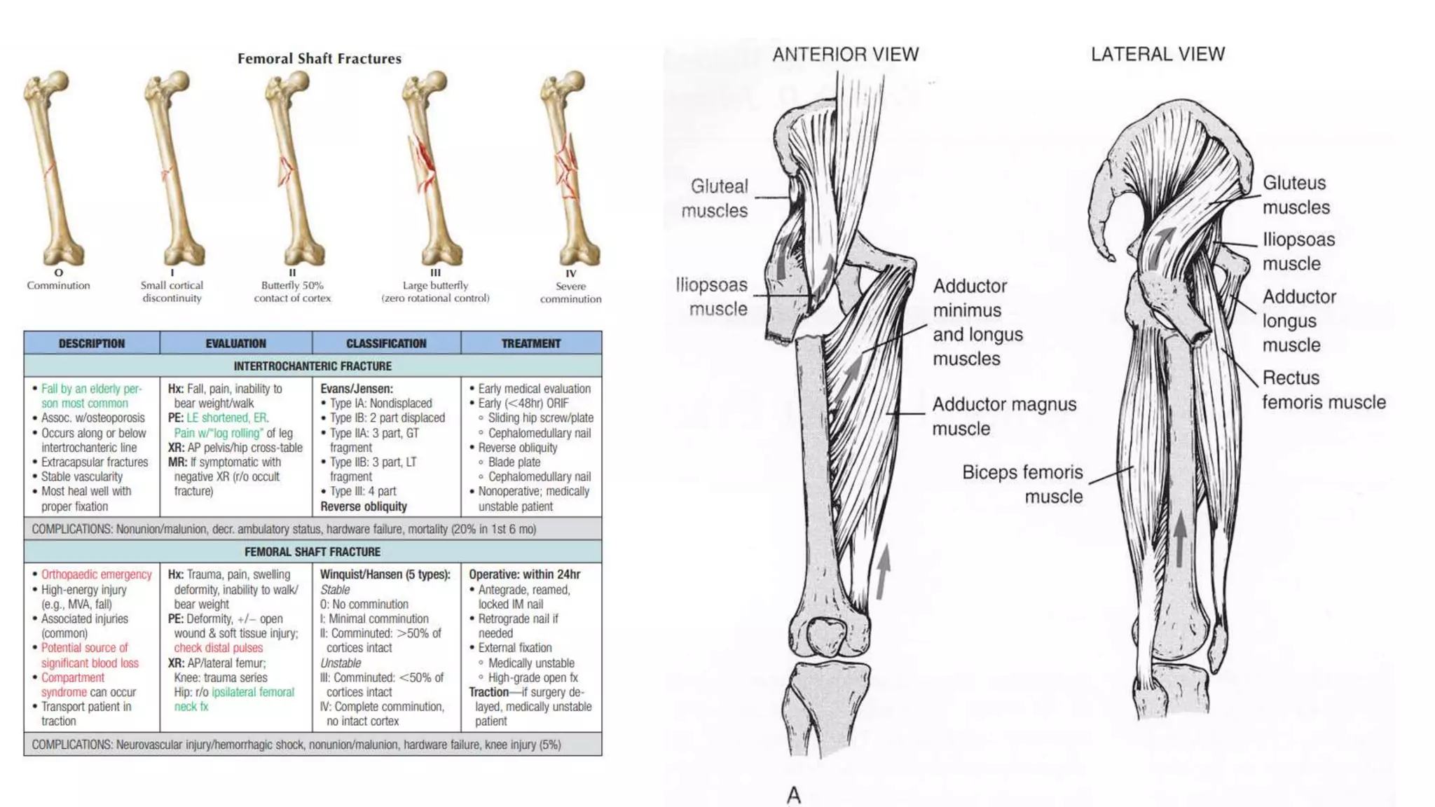MCR shaft femur.pptx