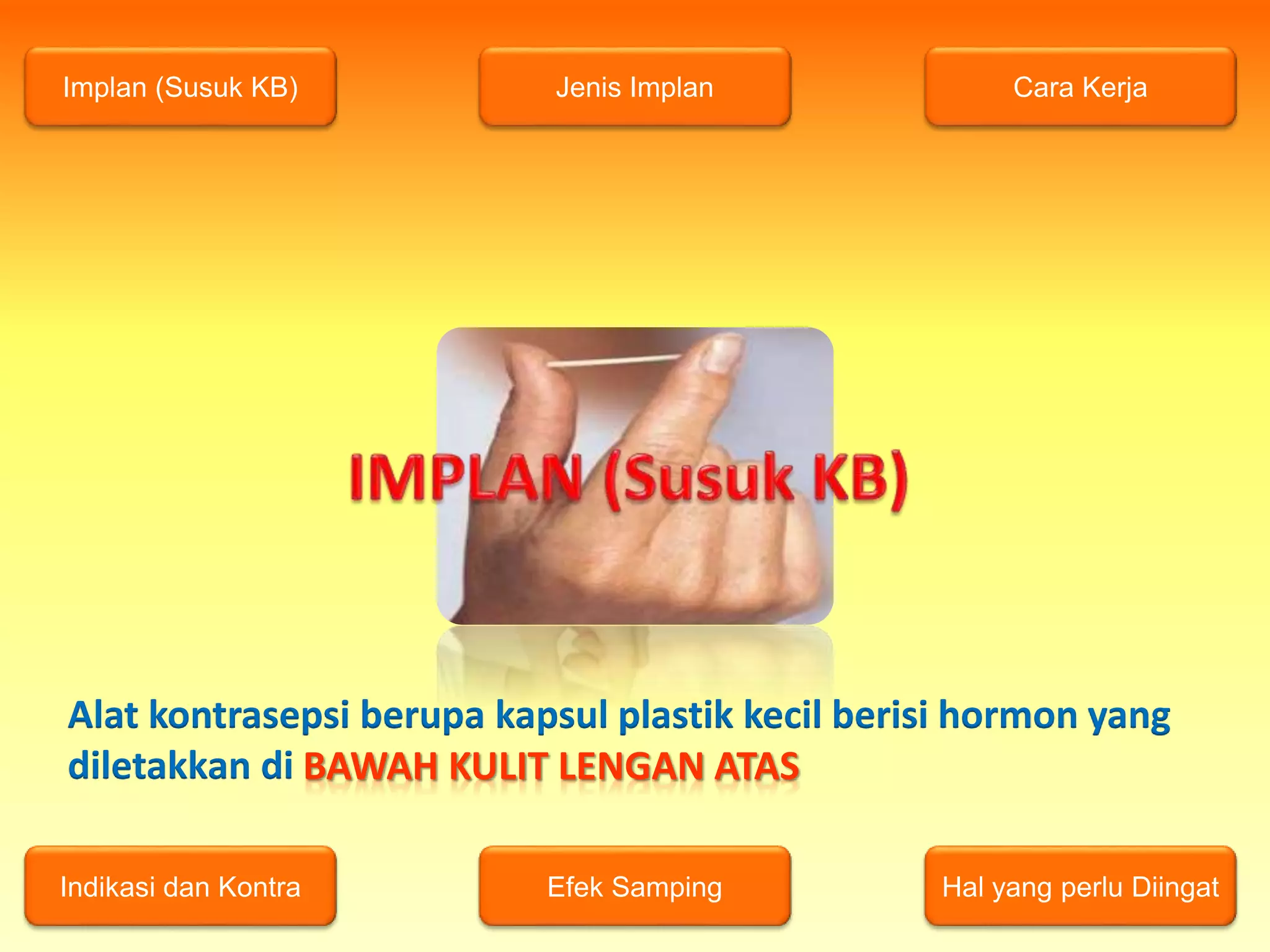 Kb Implan | PPTX