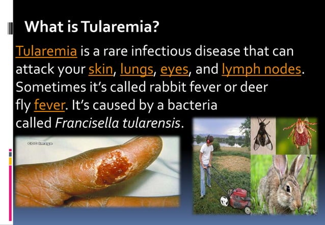 Tularemia | PPTX | Infectious Diseases | Diseases and Conditions