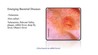 Oropharyngeal Tularemia