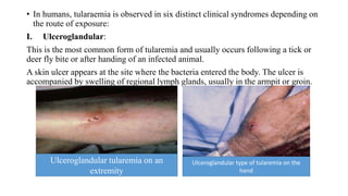 Tularemia | PPT