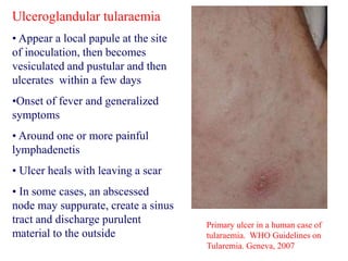 Tularemia .ppt