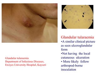 Tularemia .ppt