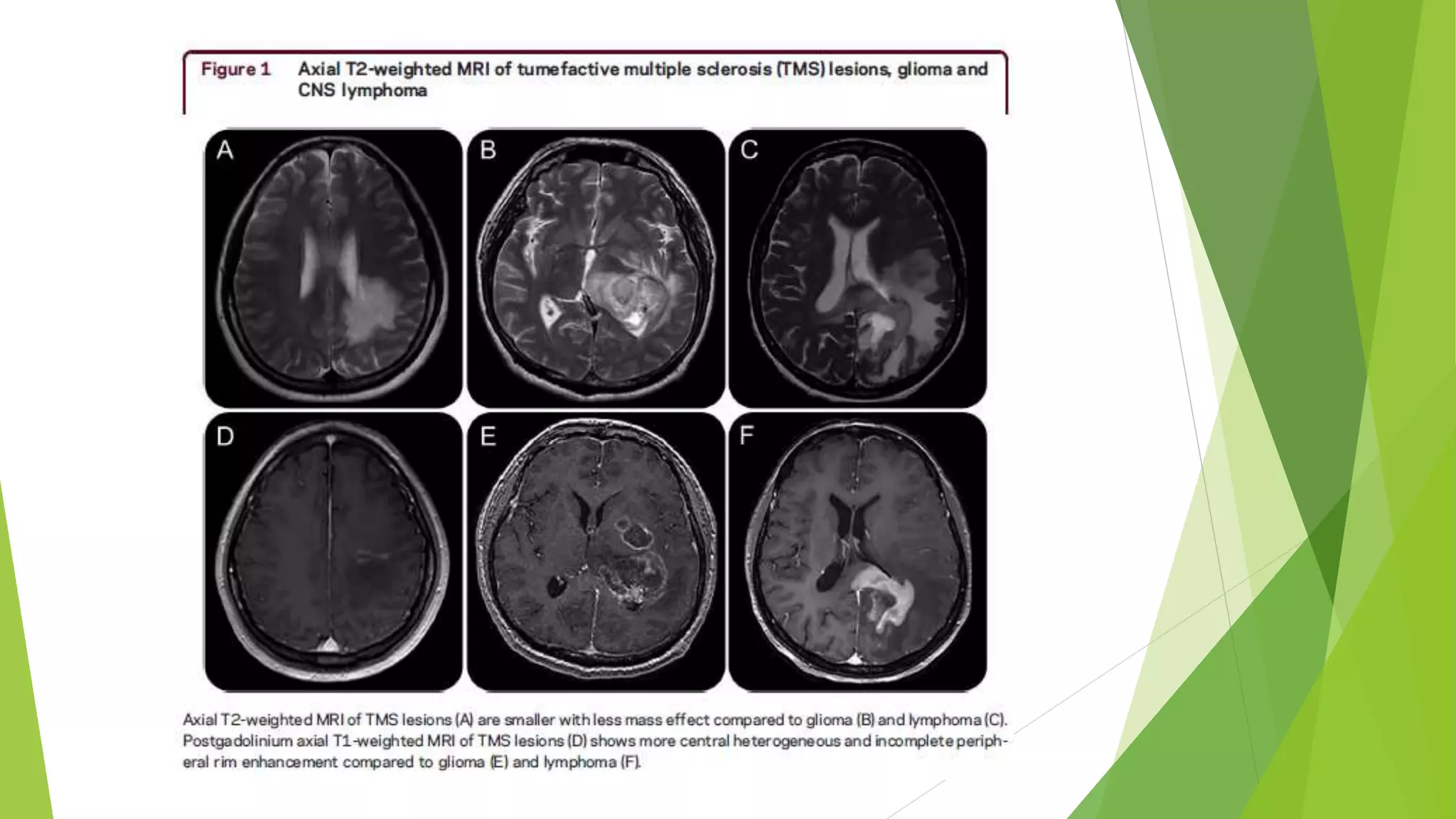 Tumefactive Demyelinating Lesions | PPTX