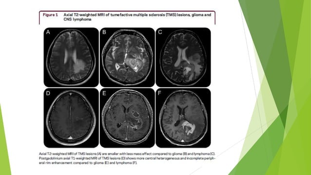 Tumefactive Demyelinating Lesions | PPT