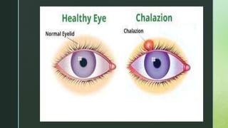 Chalazion | PPTX