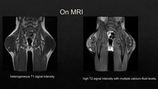 Tumoral calcinosis.pptx