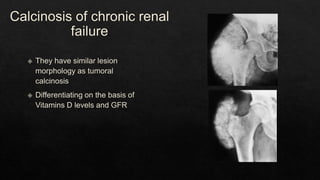 Tumoral calcinosis.pptx
