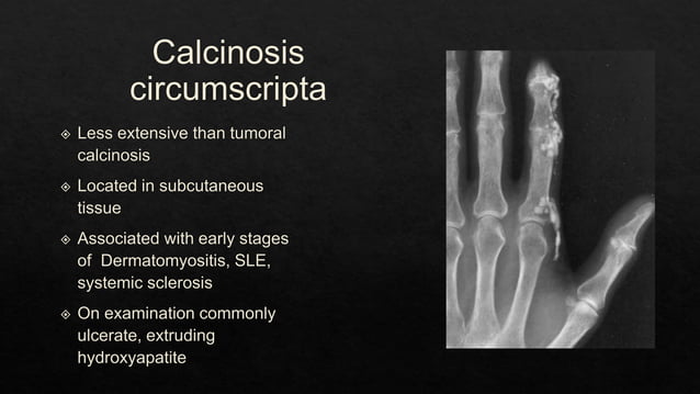 Tumoral calcinosis.pptx | Death, Injury, or Military Conflict ...