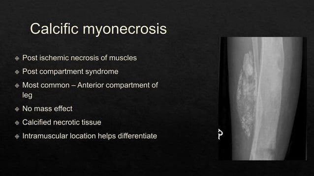 Tumoral calcinosis.pptx | Death, Injury, or Military Conflict ...