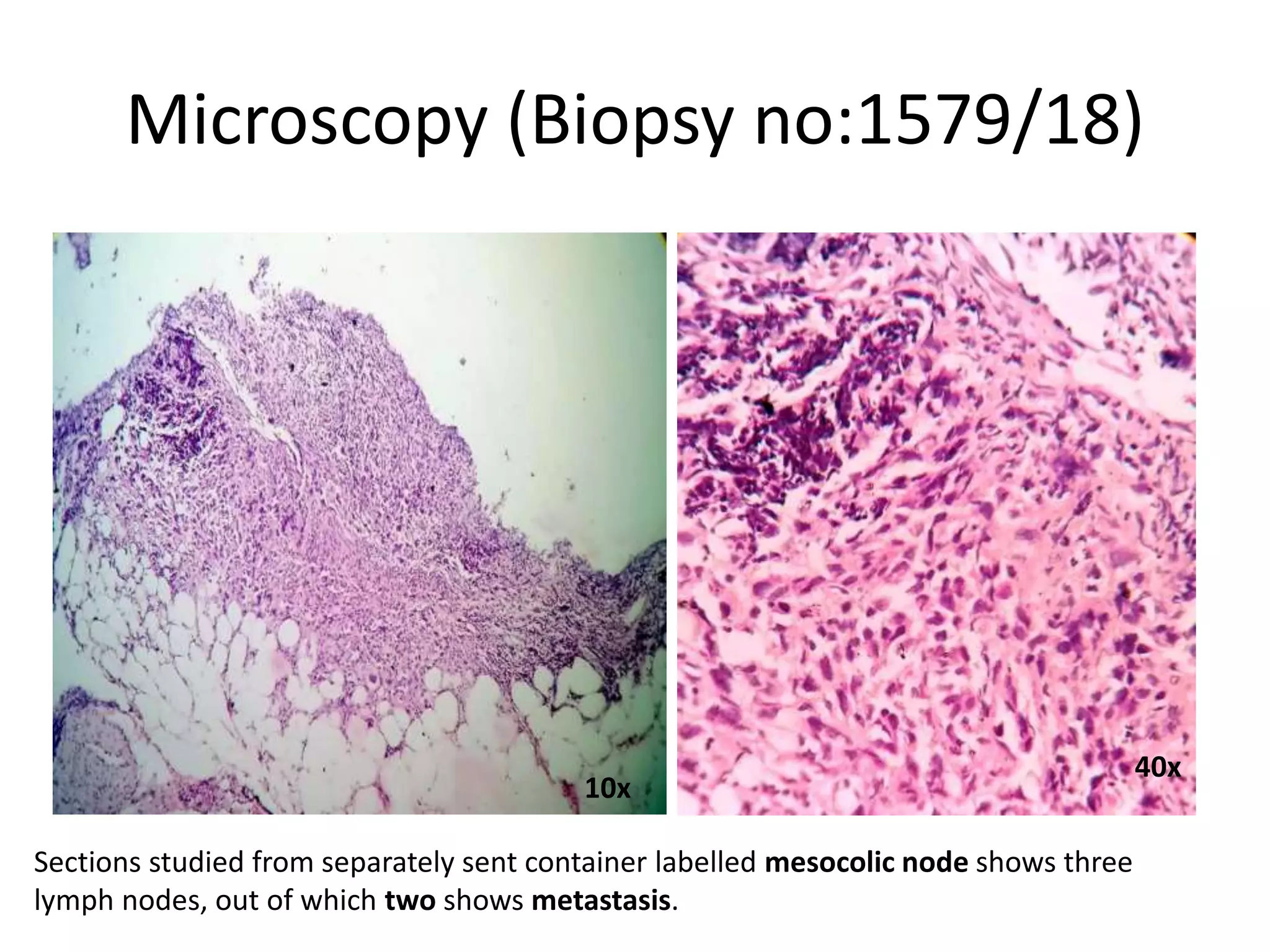 Tumor board ca stomach 28082018 | PPTX