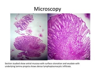 Tumor board ca stomach 28082018 | PPTX