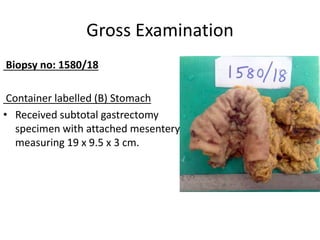 Tumor board ca stomach 28082018 | PPTX