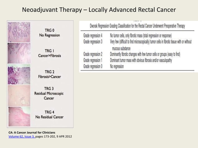 Tumor board locally advanced rectal cancer | PPT