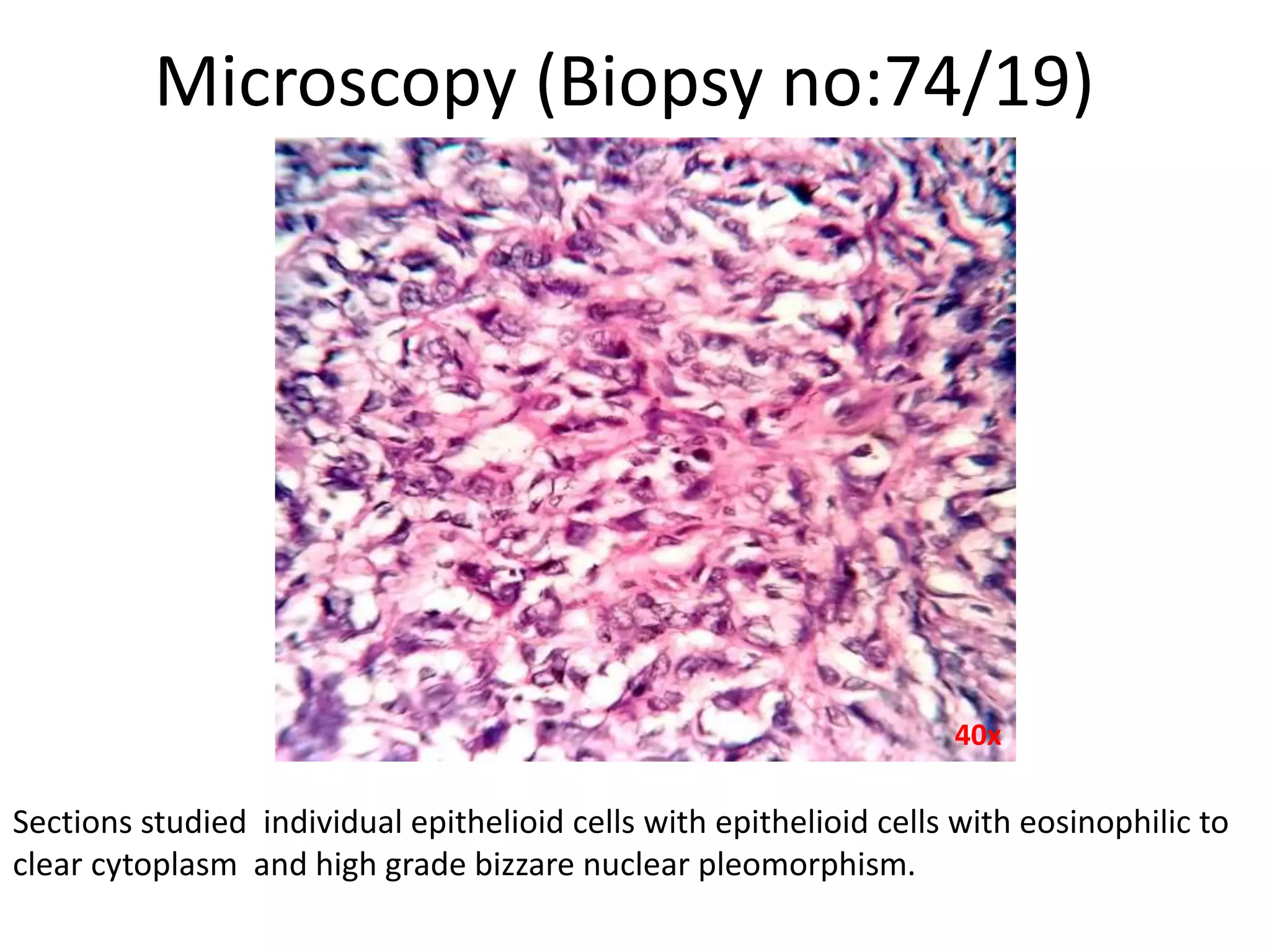 Tumor board soft tissue sarcoma | PPT