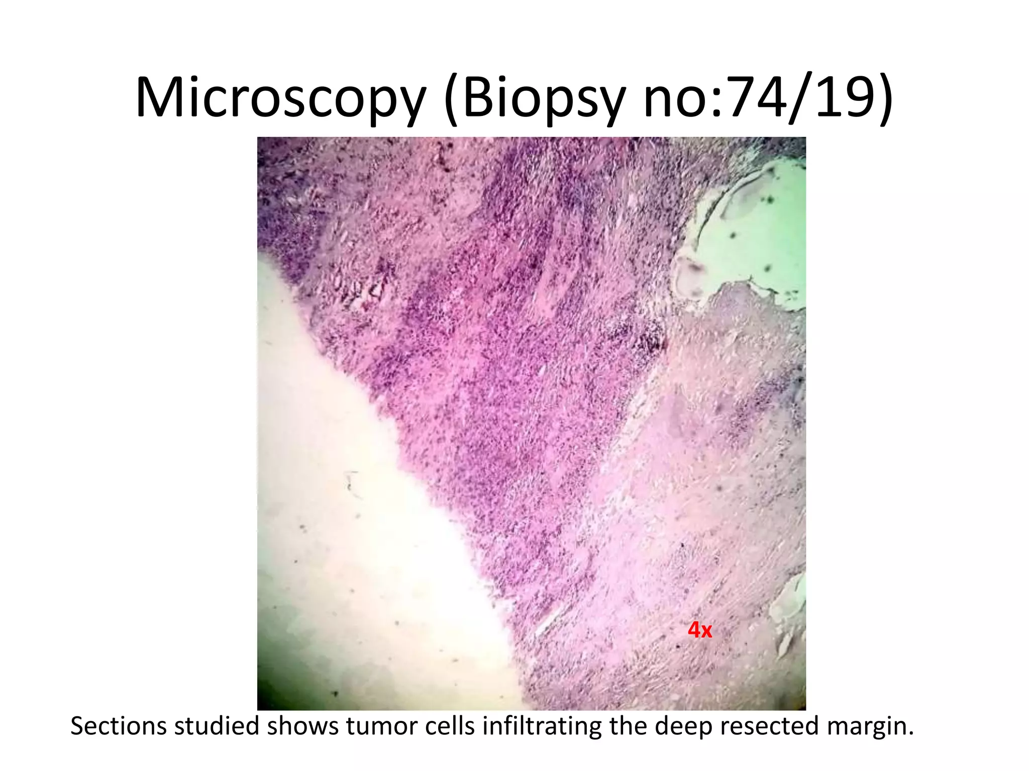 Tumor board soft tissue sarcoma | PPT