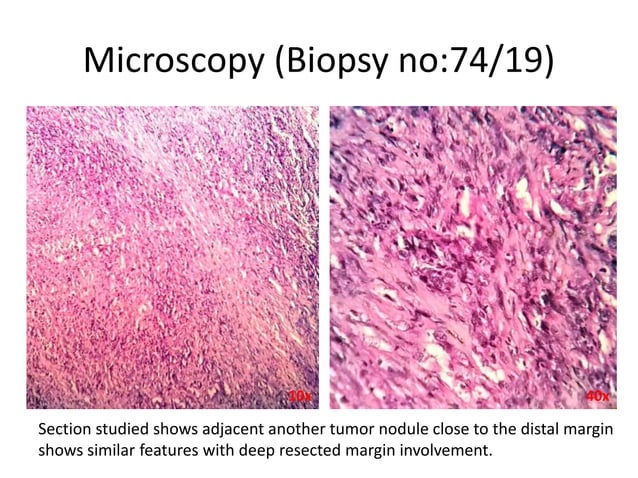 Tumor board soft tissue sarcoma | PPT