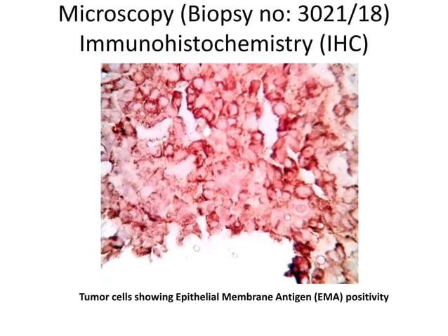 Tumor board soft tissue sarcoma | PPT