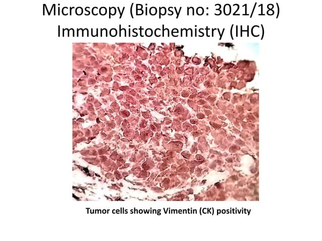 Tumor board soft tissue sarcoma | PPT