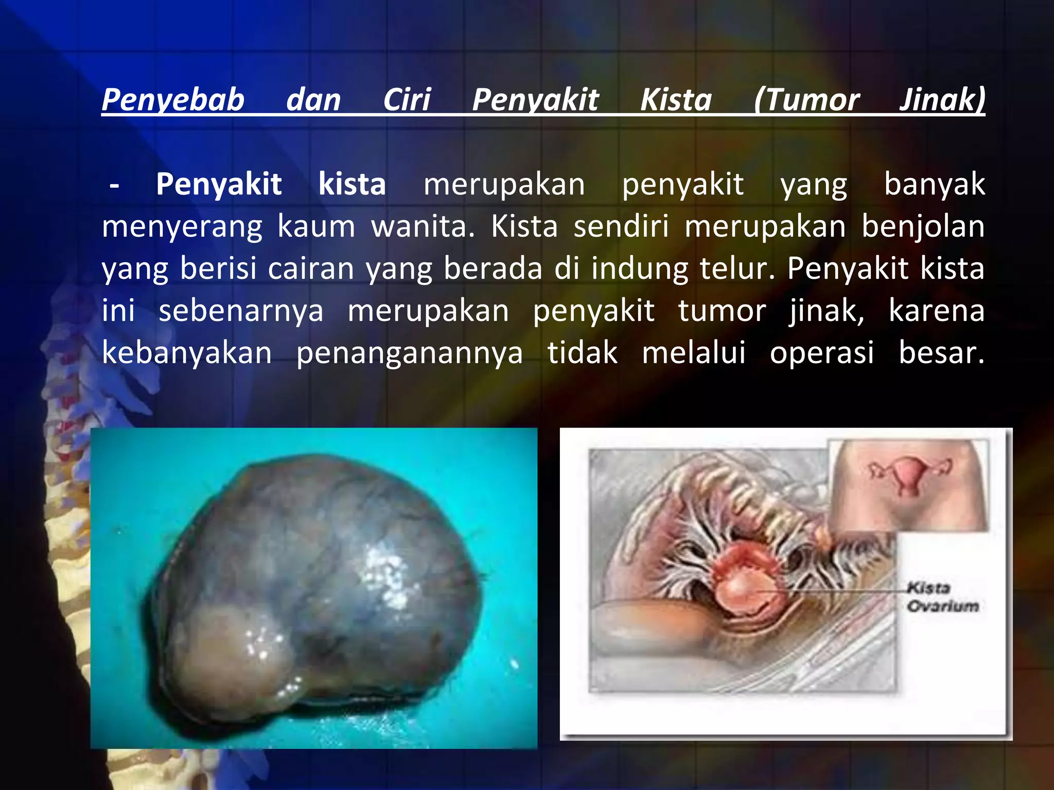 Tumor dan kanker | PPTX