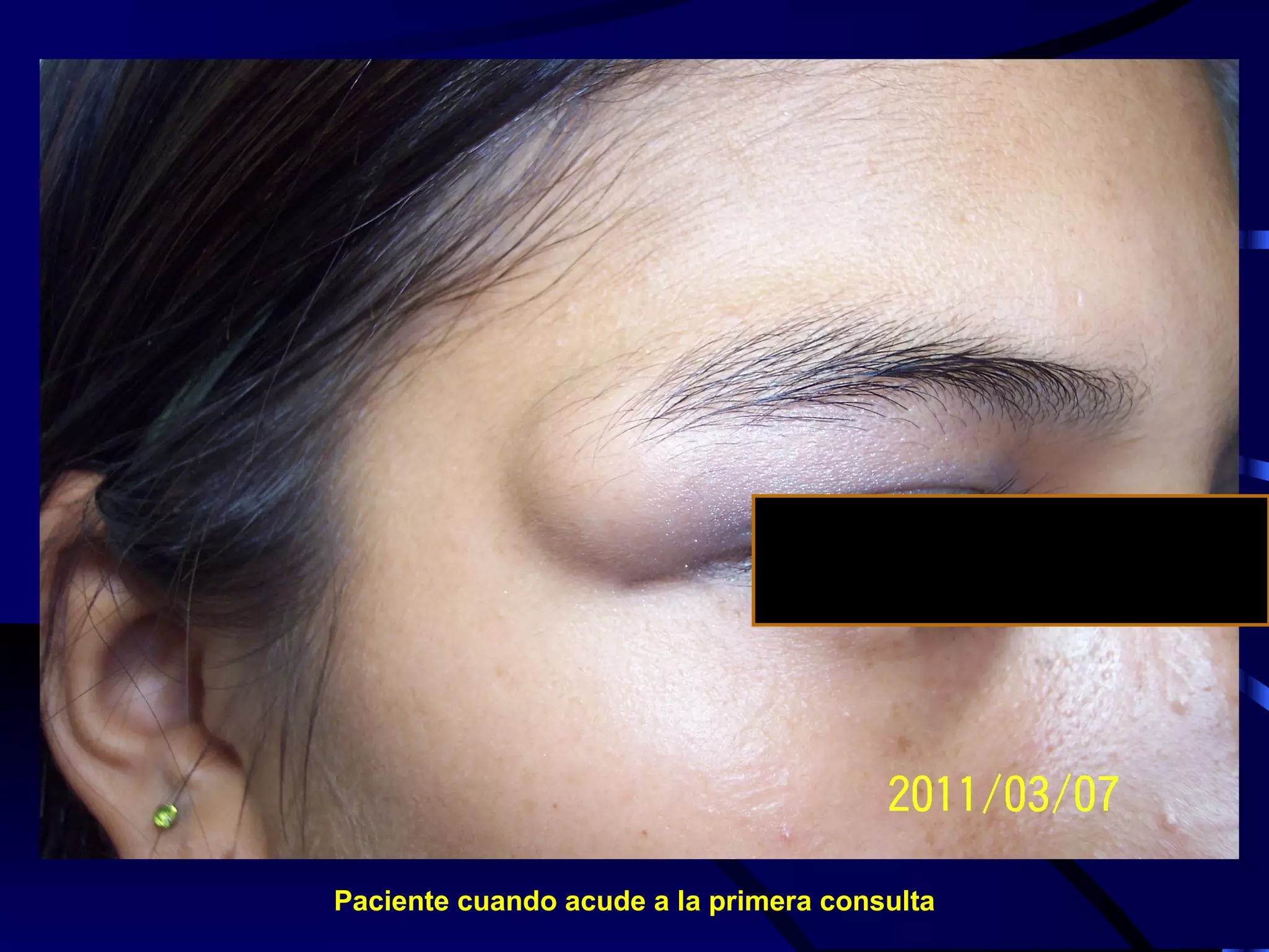 CASO TIPICO DE QUISTE DERMOIDE EN COLA DE CEJA | PPT