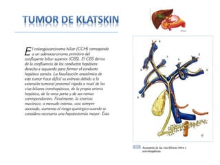 Tumor de klatskin | PPT