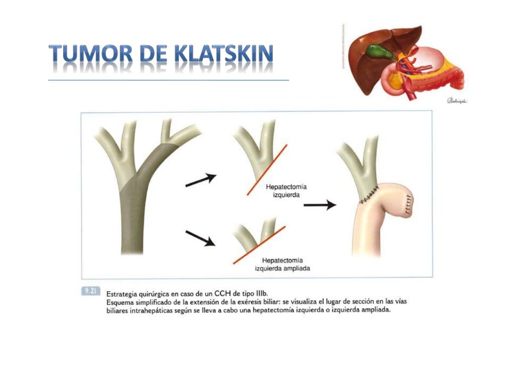 Tumor De Klatskin Tem Cura - RETOEDU