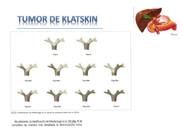 Tumor de klatskin