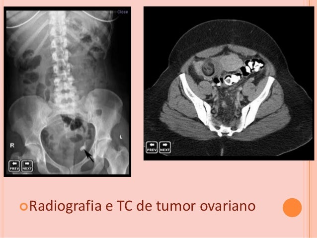 Tumor de Ovário