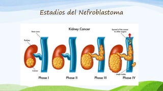 Tumor de wilms | PPTX