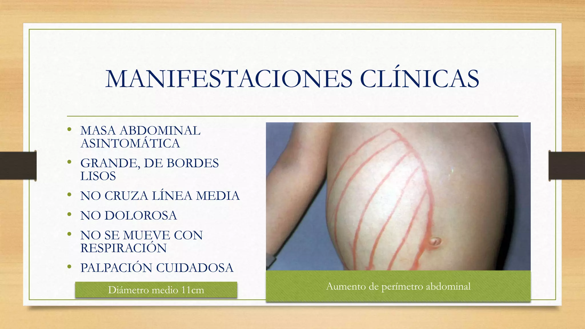 Tumor de wilms o nefroblastoma | PPTX