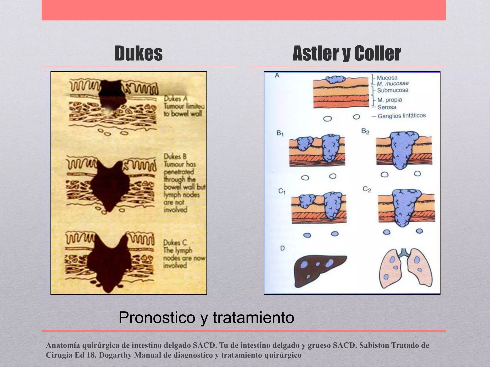 Tumores de intestino delgado y grueso | PPTX