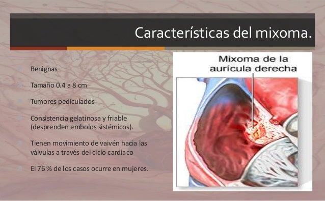 Tumores cardiacos