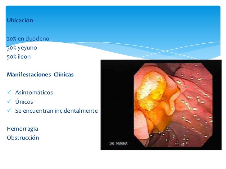 Tumores benignos de intestino delgado