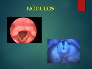 TUMORES BENIGNOS DE LARINGE | PPT