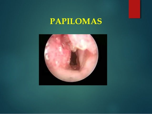 TUMORES BENIGNOS DE LARINGE