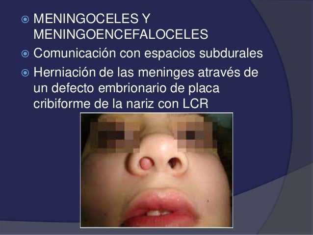 Tumores benignos de nariz y senos paranasales